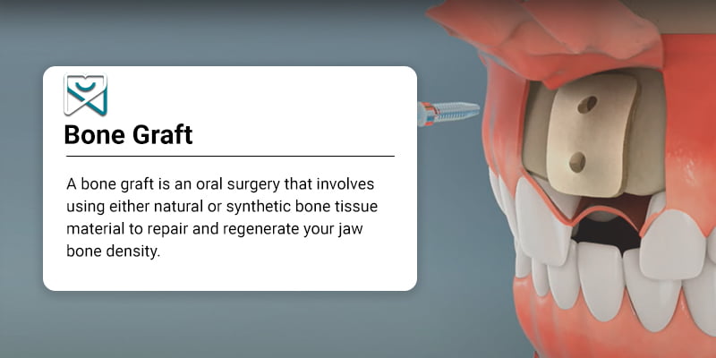 Bone Grafting for Dental Implants in Manhattan, NYC | Dental Bone Graft