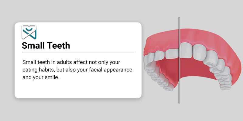 Small Teeth Treatment Options in Greenwich Village, Lower Manhattan, NY