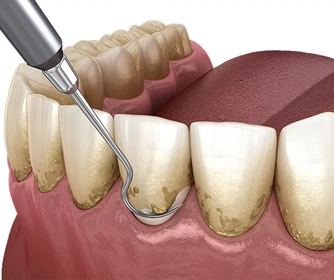 Professional Teeth Cleaning