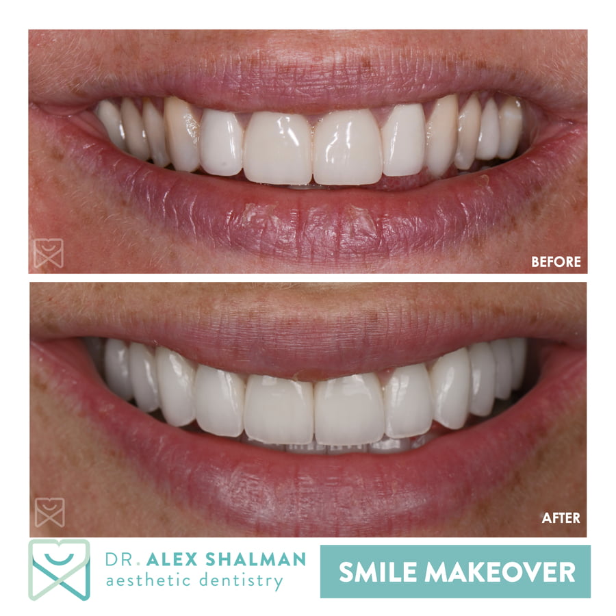 Teeth Veneers NYC | Porcelain Dental Veneers Lower Manhattan