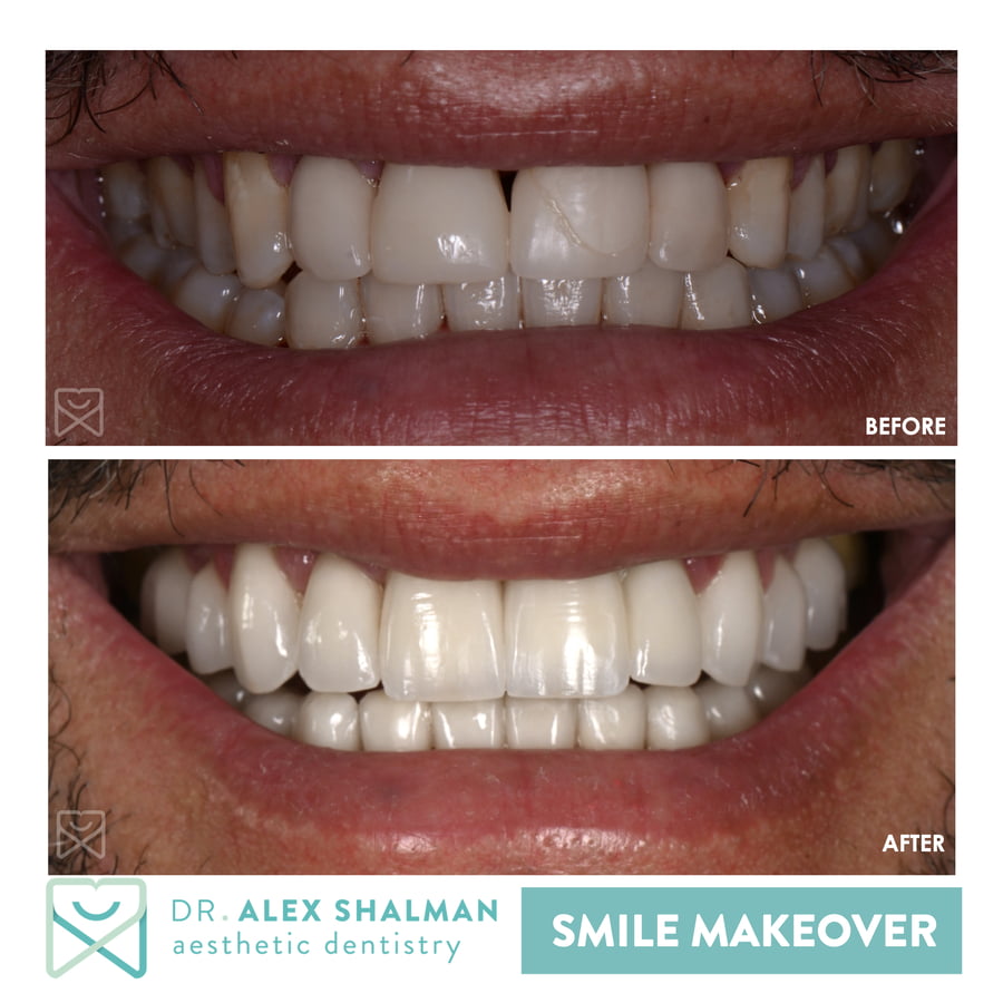 Teeth Veneers NYC | Porcelain Dental Veneers Lower Manhattan