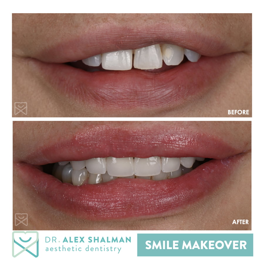 Teeth Veneers NYC | Porcelain Dental Veneers Lower Manhattan